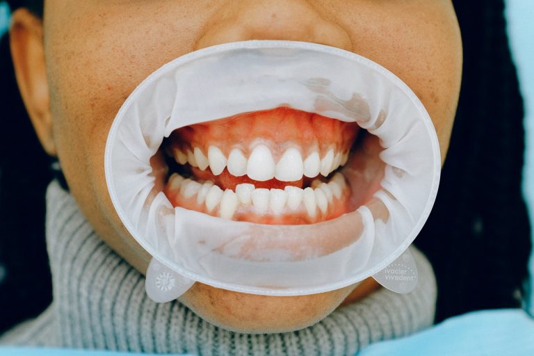 Tratamente eficiente in caz de retractie gingivala - Tratamente Naturiste